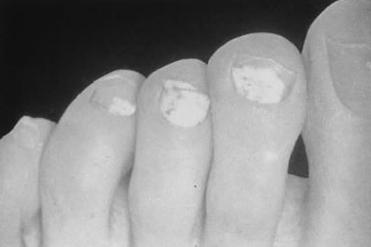 the Origins and Unique Symptoms of Nail Fungus - Swipit