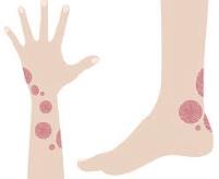 Understanding the Causes of Plaque Psoriasis: A Different Perspective ...