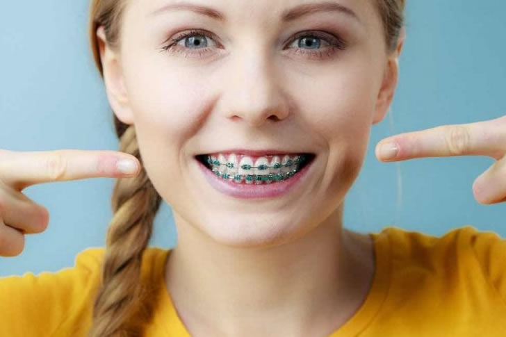 A Comprehensive Guide To Braces - Swipit